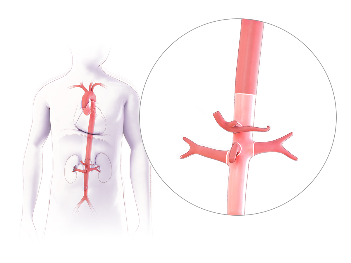 Abdominal Aorta Diagram